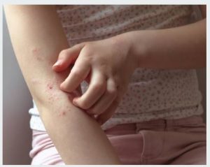 Butlig sa kamay at paa ng bata - Gamot Sa Bata