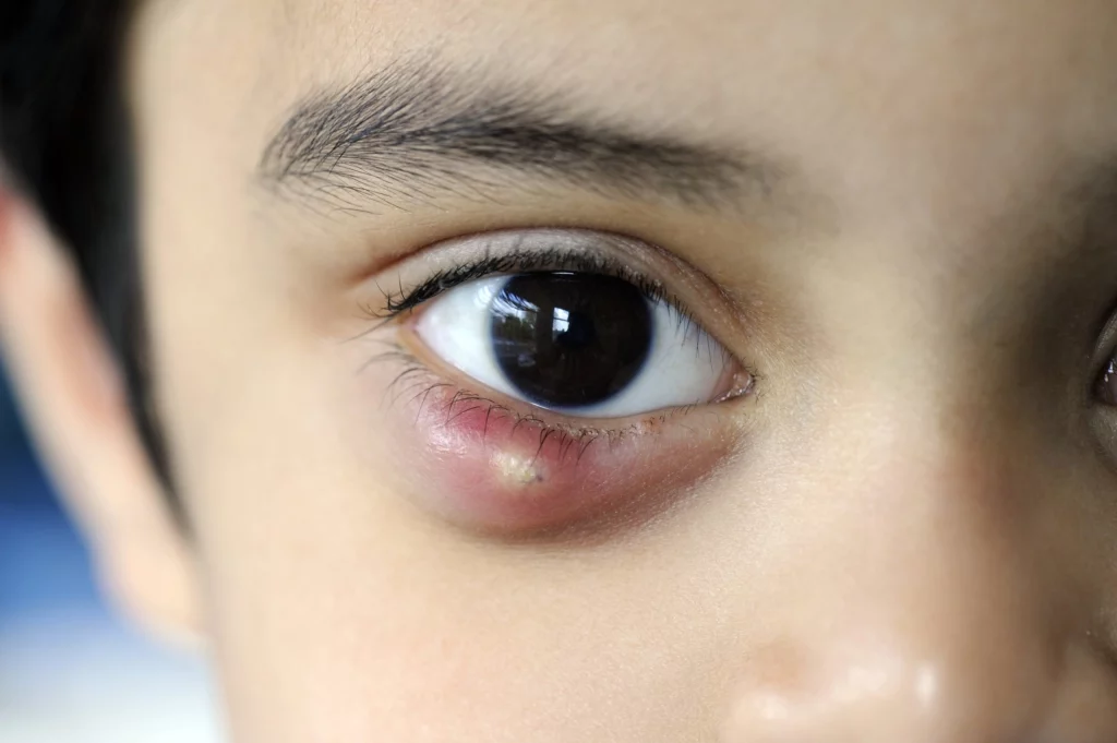 Gamot sa Pigsa sa Mata ng Bata : Kaibahan ng Pigsa sa Kuliti - Gamot Sa ...